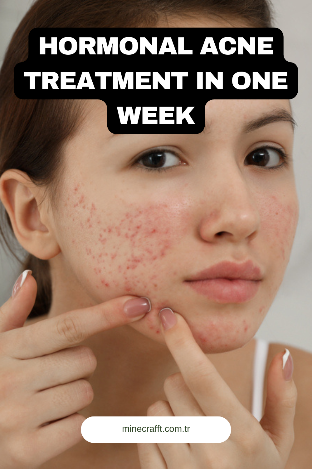 What To Eat For Hormonal Acne: 12 Foods That Clear Skin From The Inside ...